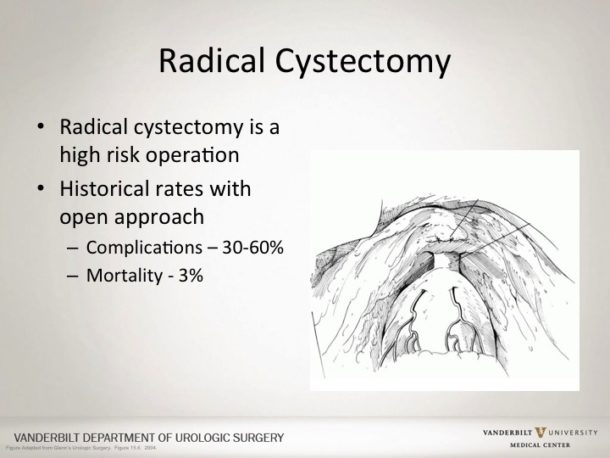Sam S. Chang | Robotic Cystectomy Versus Open Cystectomy