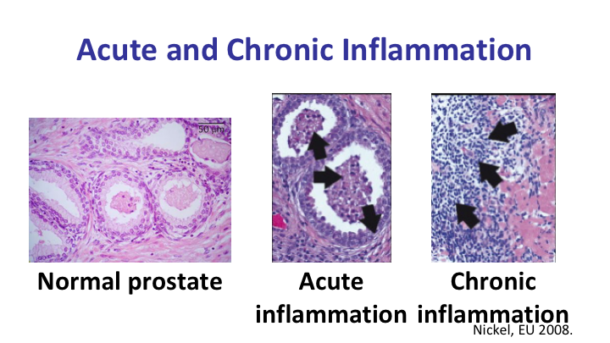 Prostate Inflammation and Prostate Cancer | What do I need to know?