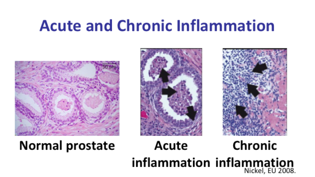 Prostate Inflammation and Prostate Cancer | What do I need to know?