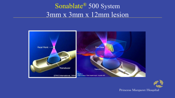 Current Findings on High Intensity Focused Ultrasound | HIFU