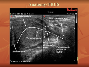 Roberto Miano, MD | Transperineal Prostate Biopsy: State of the Art