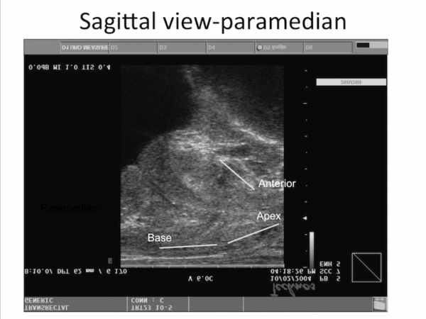 Roberto Miano, MD | Transperineal Prostate Biopsy: State of the Art