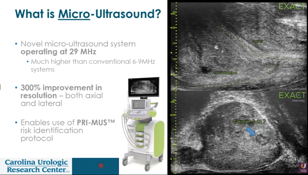 Micro-Ultrasound System for Improving Transrectal Prostate Biopsy