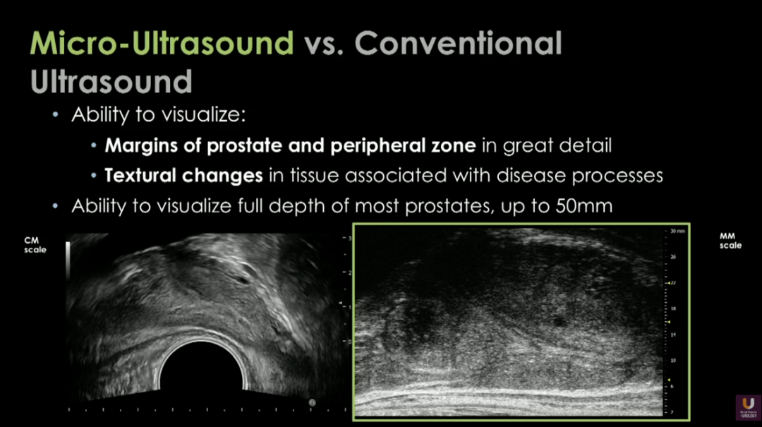 29 Mhz High Resolution Micro Ultrasound For Improved Prostate Biopsy