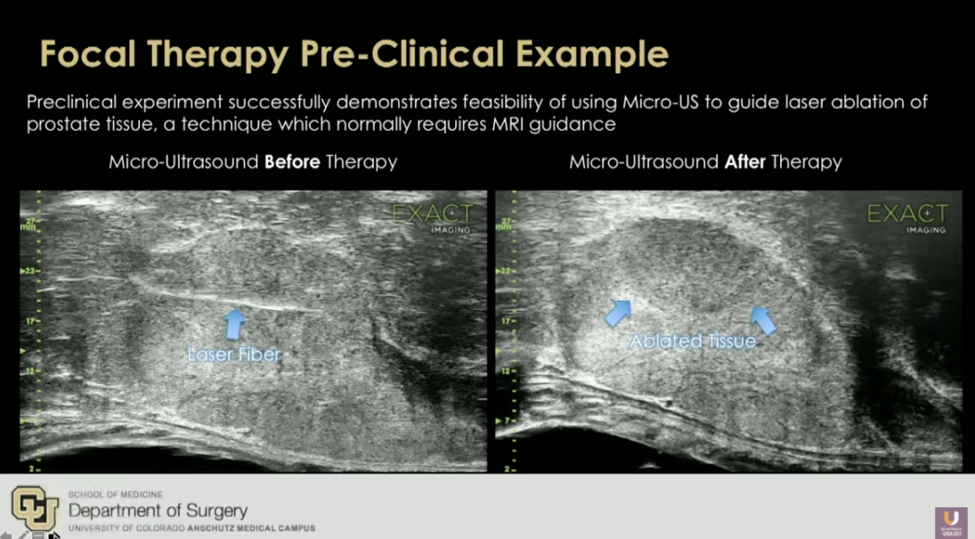 Clinical Possibilities in Prostate Cancer with Micro-Ultrasound
