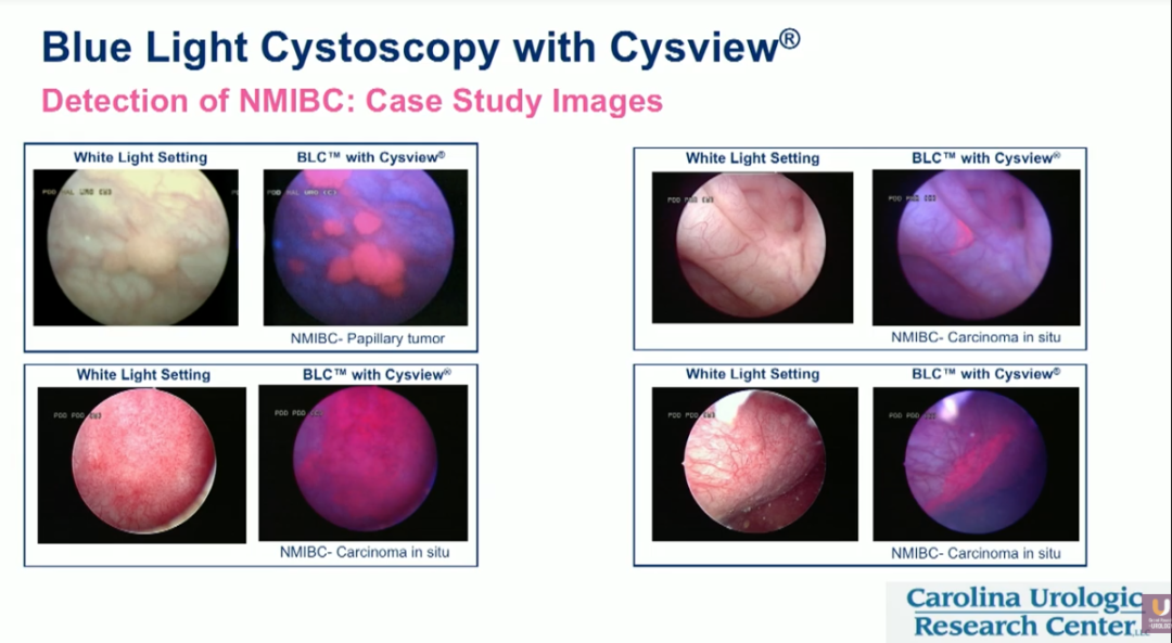 Gold Standard for Bladder Cancer Detection | Blue Light Cystoscopy