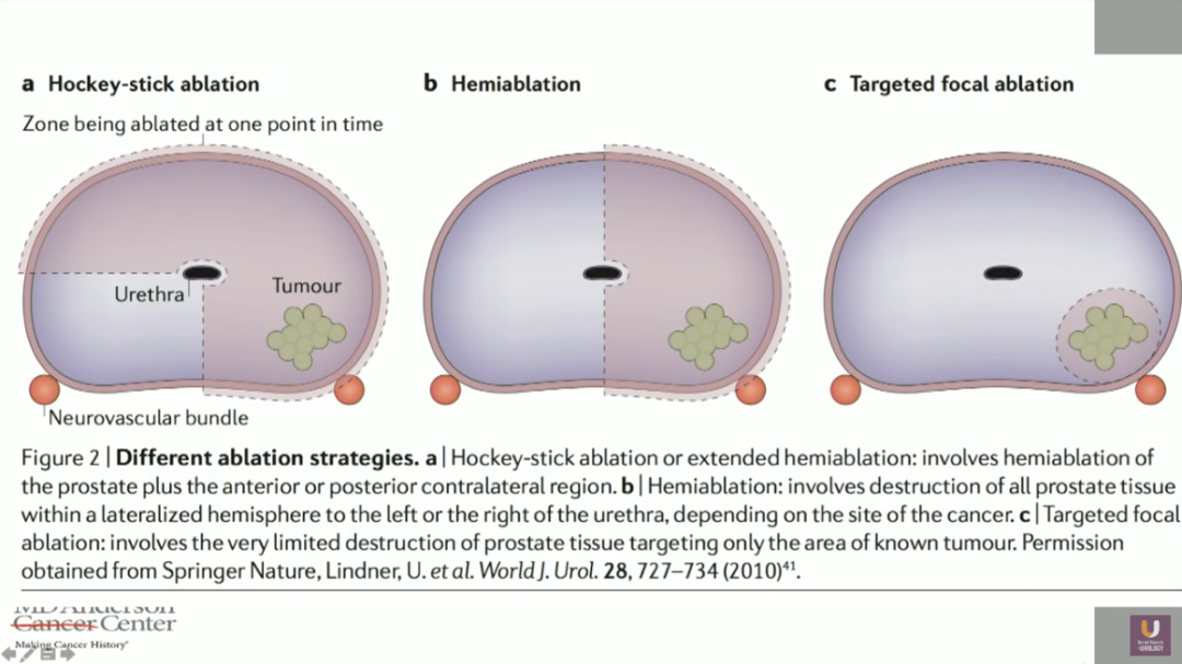 Focal Therapy for Localized Prostate Cancer: Is There a “Middle Ground”