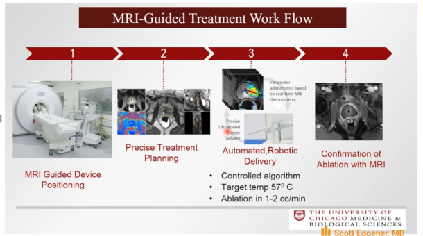 MRI-Guided Transurethral Ultrasound Ablation in Men with Localized PCa