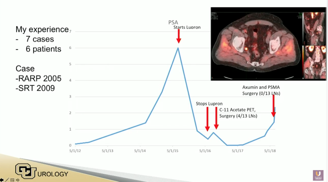 Salvage Lymph Node Dissection for Prostate Cancer