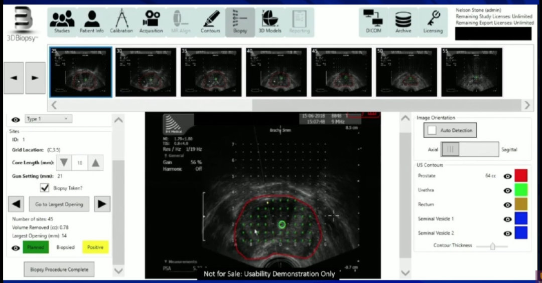Transperineal Mapping Biopsy Defines Tumor Type and Location