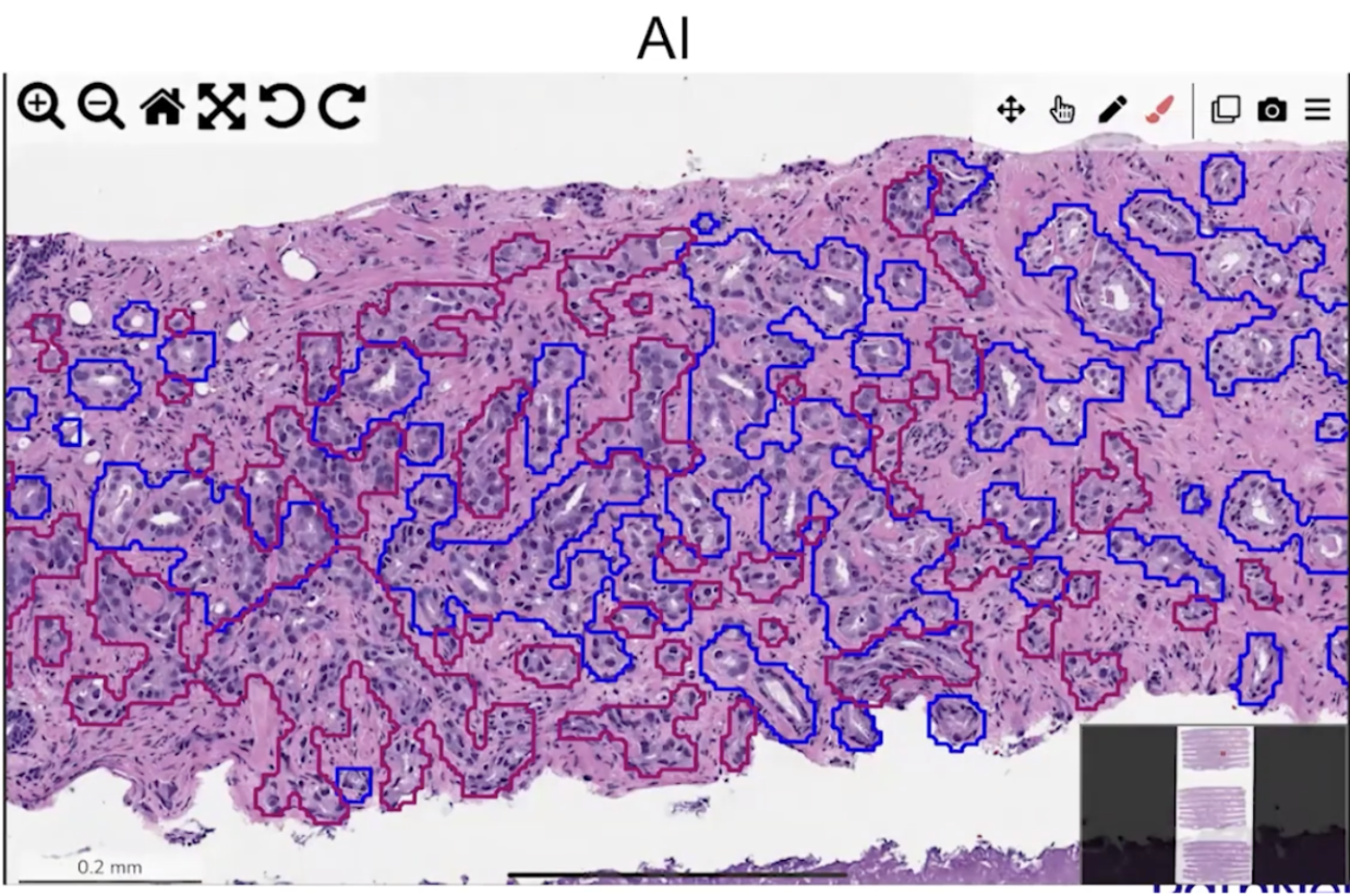 TruCore Digital Pathology for Prostate Cancer Detection