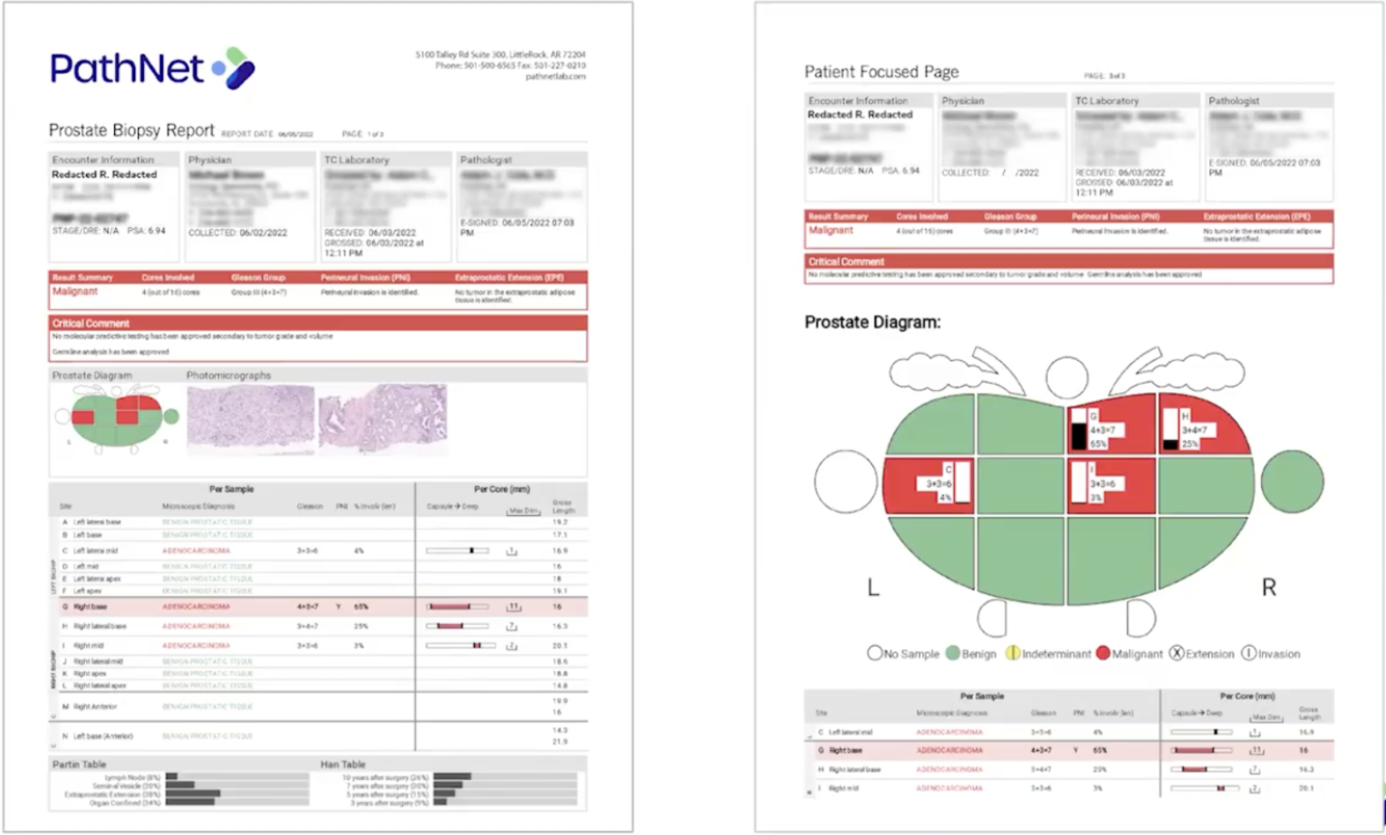TruCore Digital Pathology for Prostate Cancer Detection